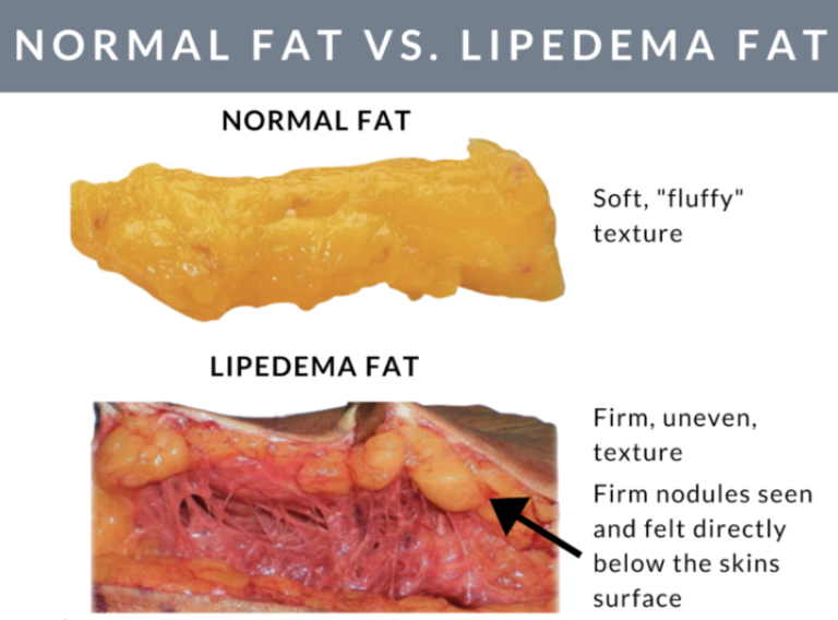 Lipedema Fat vs Normal Fat | How to Tell them Apart - Lipedema and Me