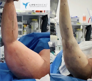 Lipedema in the Upper Arms - Lipedema and Me
