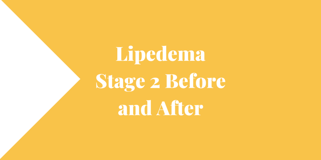 Lipedema Stage 2 Before and After - Lipedema and Me