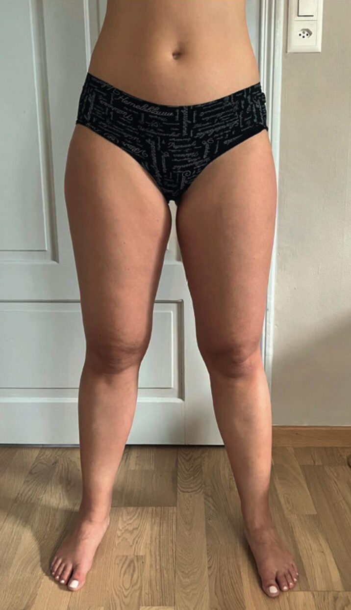 Lipedema Stage 1 Before and After - Lipedema and Me