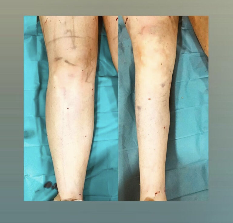 Lipedema Reduction Surgery with Lipemedical - Lipedema and Me