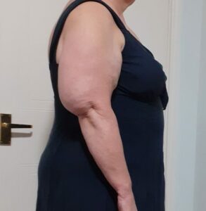 Lipedema in the Upper Arms - Lipedema and Me