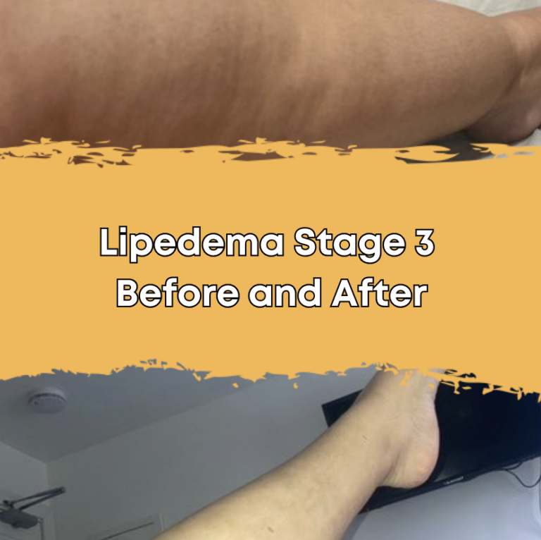 Lipedema Before and After - Lipedema and Me
